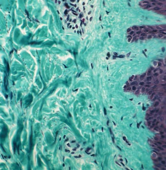 How Hydrolyzed Collagen Type One Promotes Wound Healing | Sanara MedTech