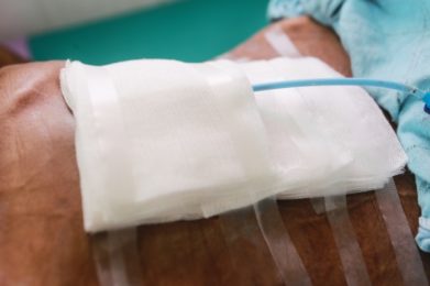 Surgical Site Drains: Benefits and Risks | Sanara MedTech