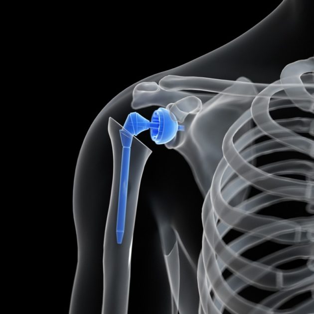 Outpatient Joint Replacements: A Guide For Patients - Sanara MedTech