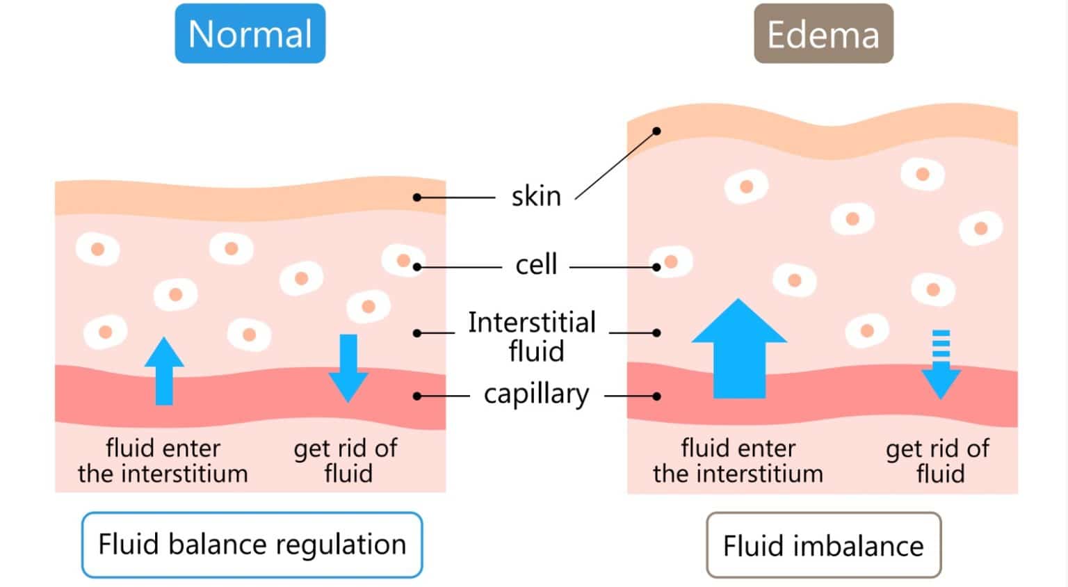 The Detrimental Impact of Swelling on Wound Healing | Sanara