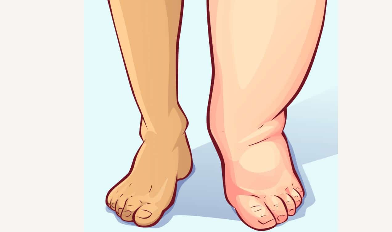 The Detrimental Impact of Swelling on Wound Healing | Sanara