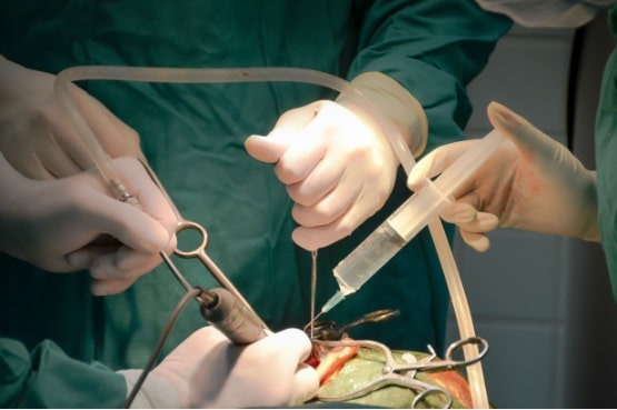 Comparing Delivery Methods of Surgical Wound Irrigation | Sanara MedTech