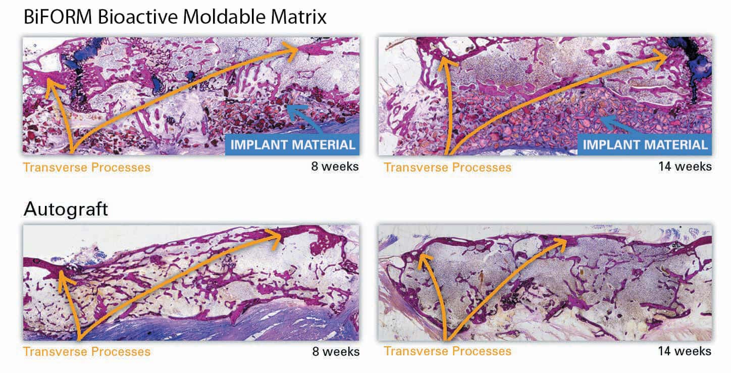 In Vitro and In Vivo Characterization of BiFORM® Bioactive Moldable ...